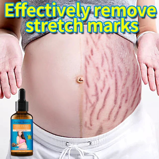 Stretch Marks Before And After Bio Oil