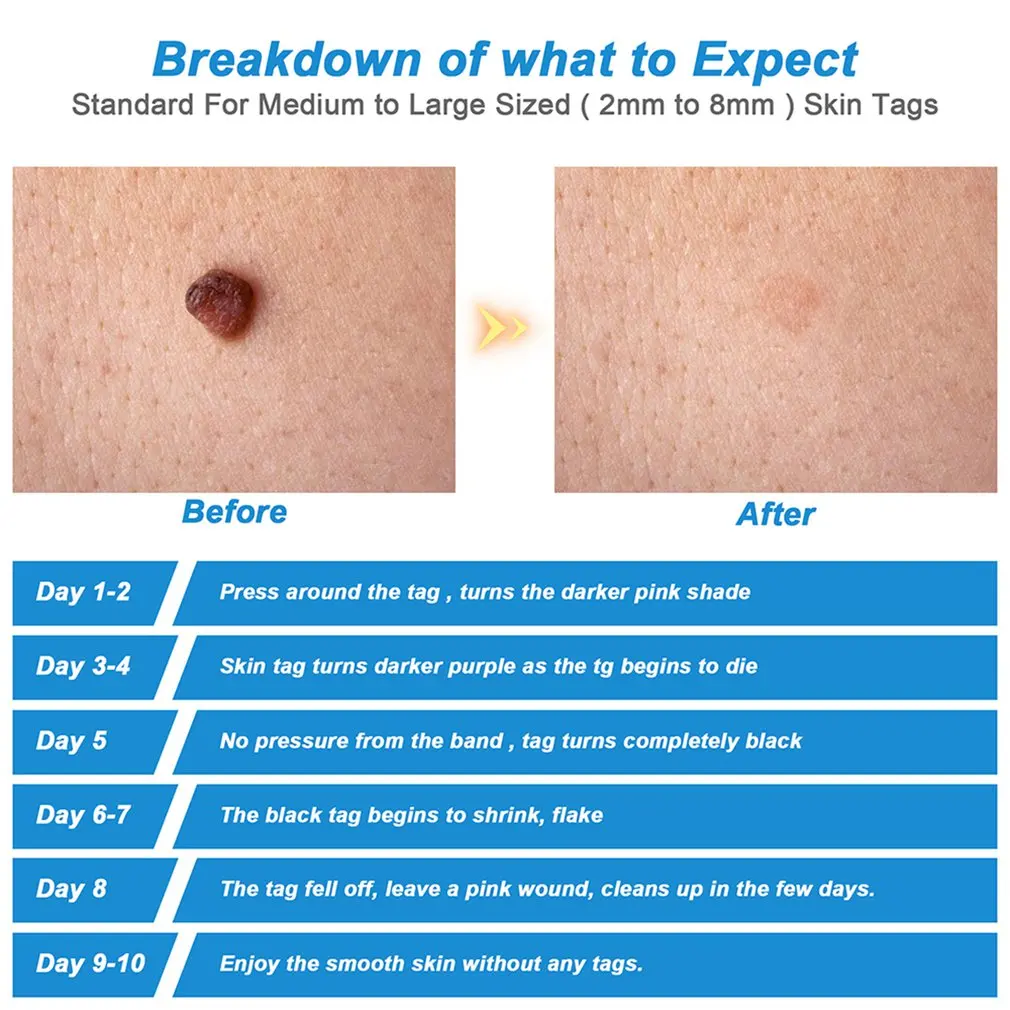 Pedunculated Skin Polyp Pedunculated Skin Polyp