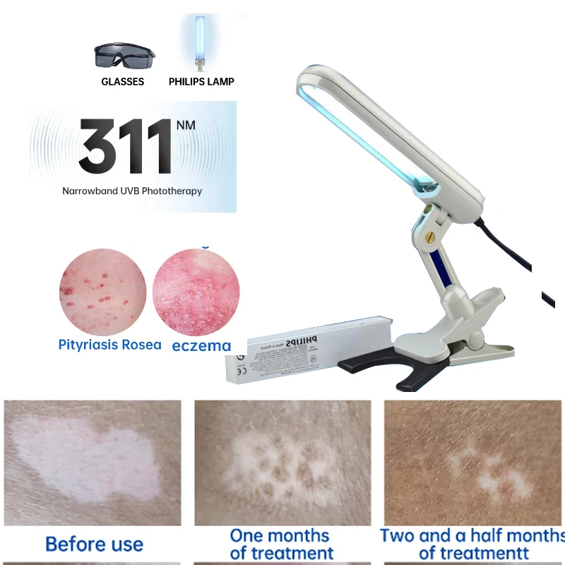 Nb-uvb Uv Phototherapy Light Instrument 311nm Narrowband Ultraviolet Uvb Lamp Treatment Anti ...