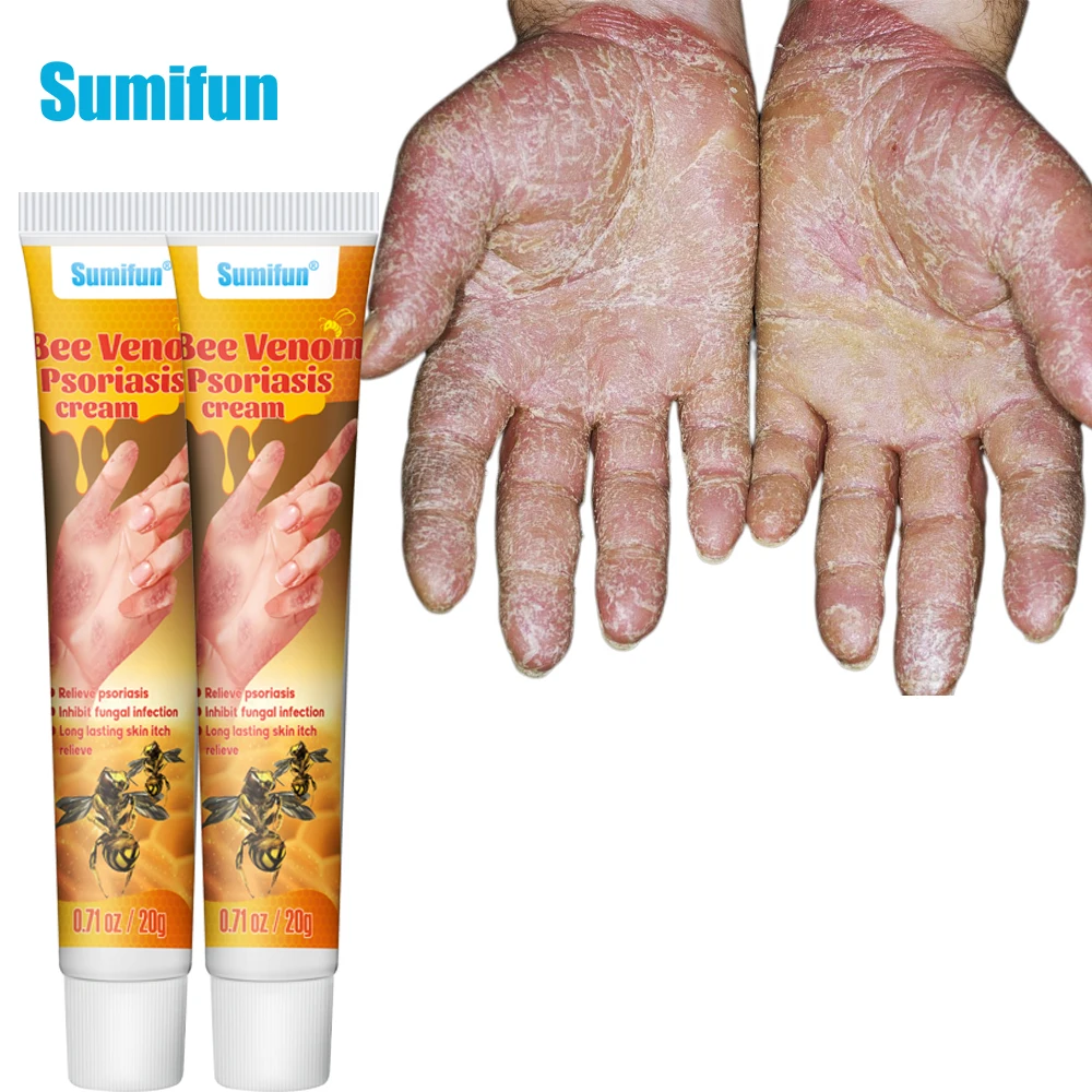 1-3-5-10pcs-Bee-Venom-Psoriasis-Cream-Treatment-Eczema-Dermatitis ...