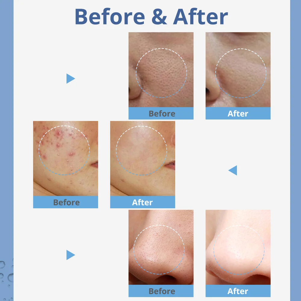 Diamond Leg Lifts: The Ultimate Guide to Skin Rejuvenation and Facial ...