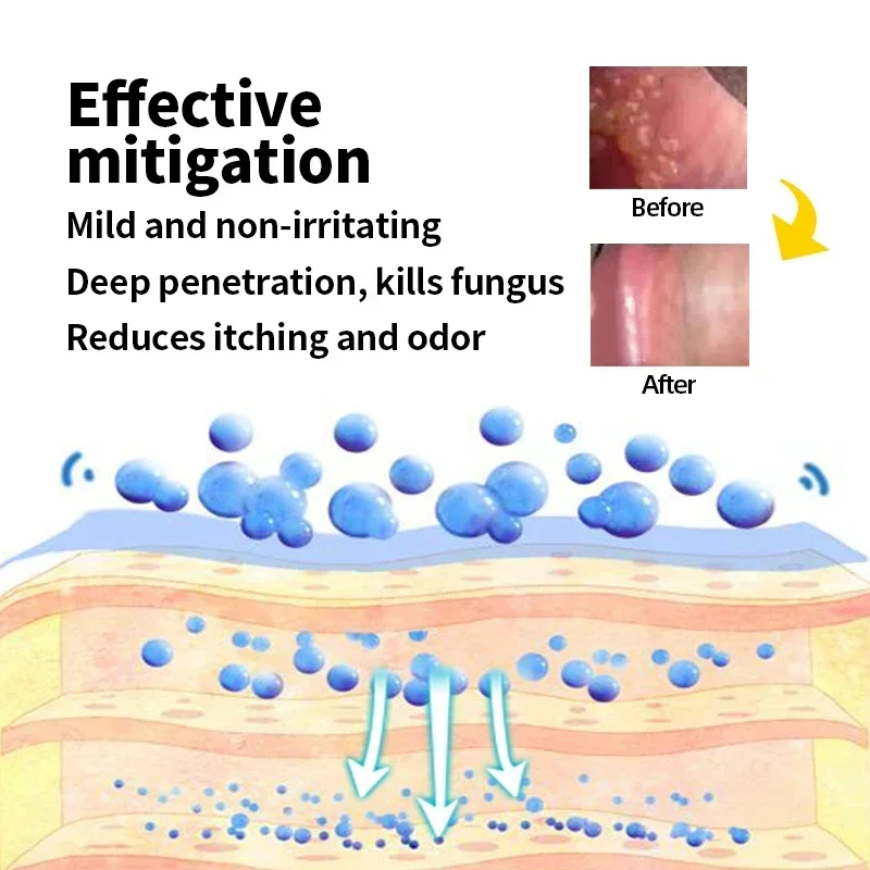Balanitis Fungal Treatment Cream Anti Infection Papules Pearl Rash Red ...