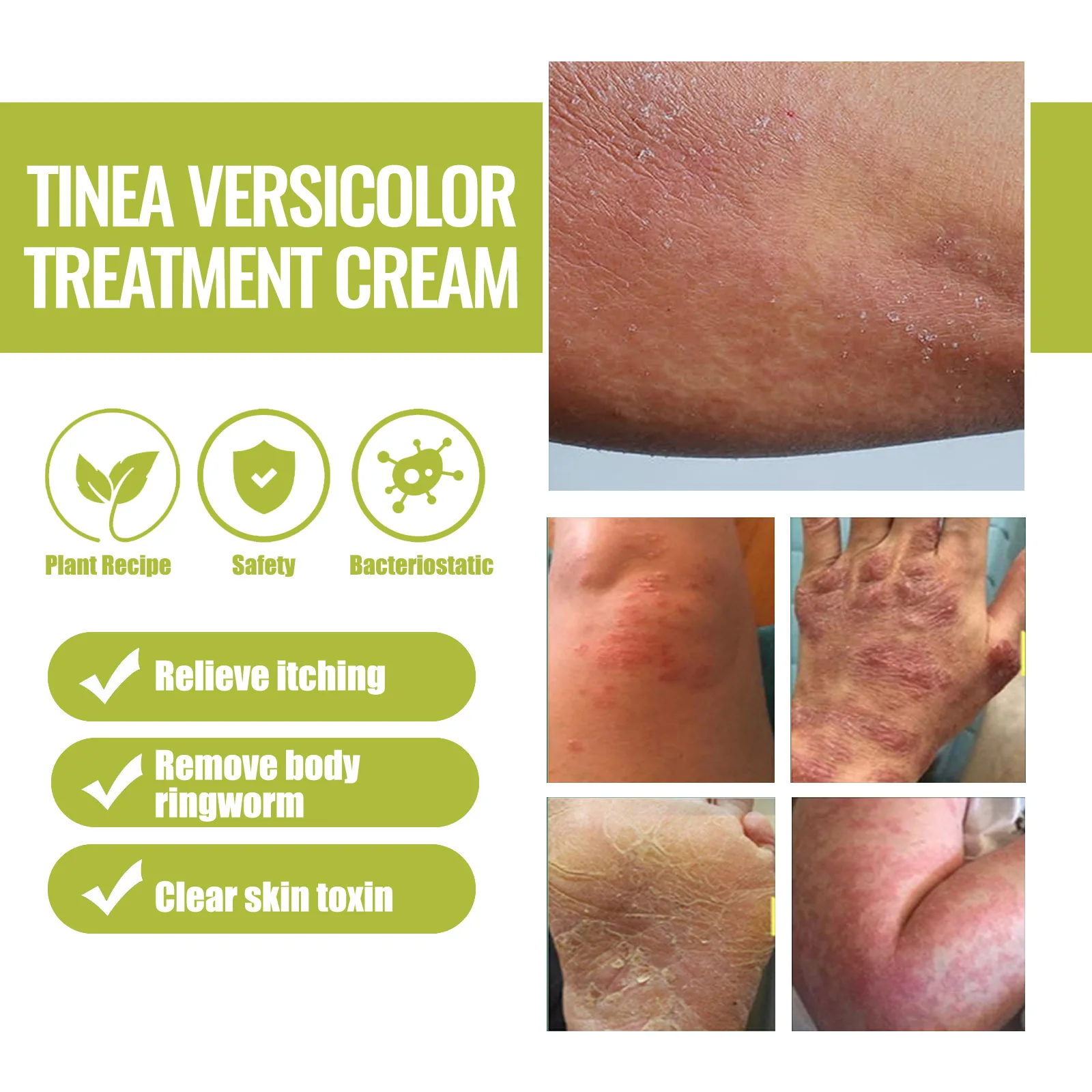 Tinea Versicolor Treatment