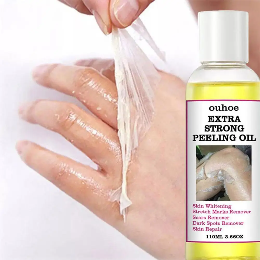 30/110ML Extra Strong Yellow Peeling Oil Whitening Lighten Elbows Knees ...