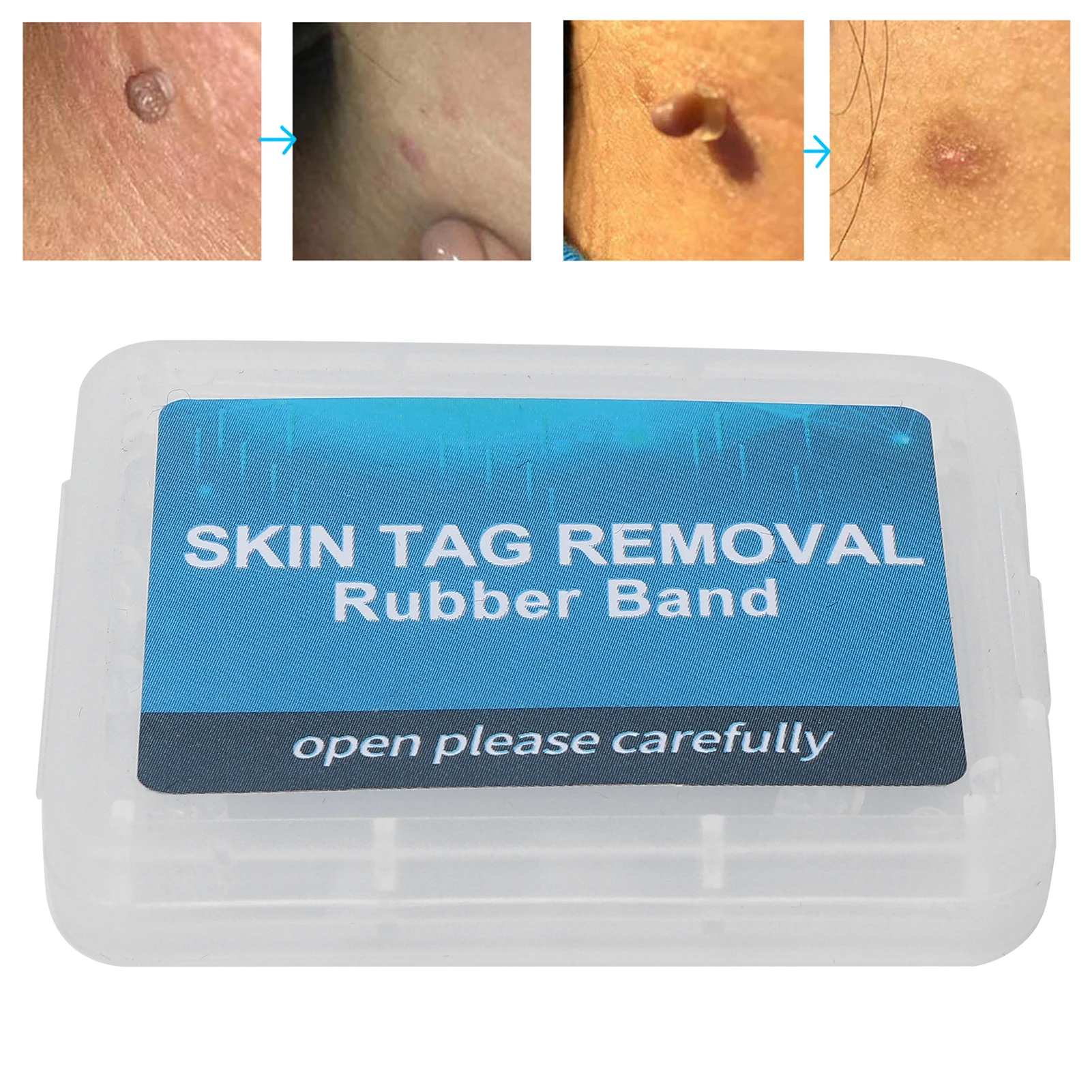 30Pcs-Painless-Skin-Tag-Removal-Kit-Mole-Wart-Remover-Micro-Skin-Tag ...