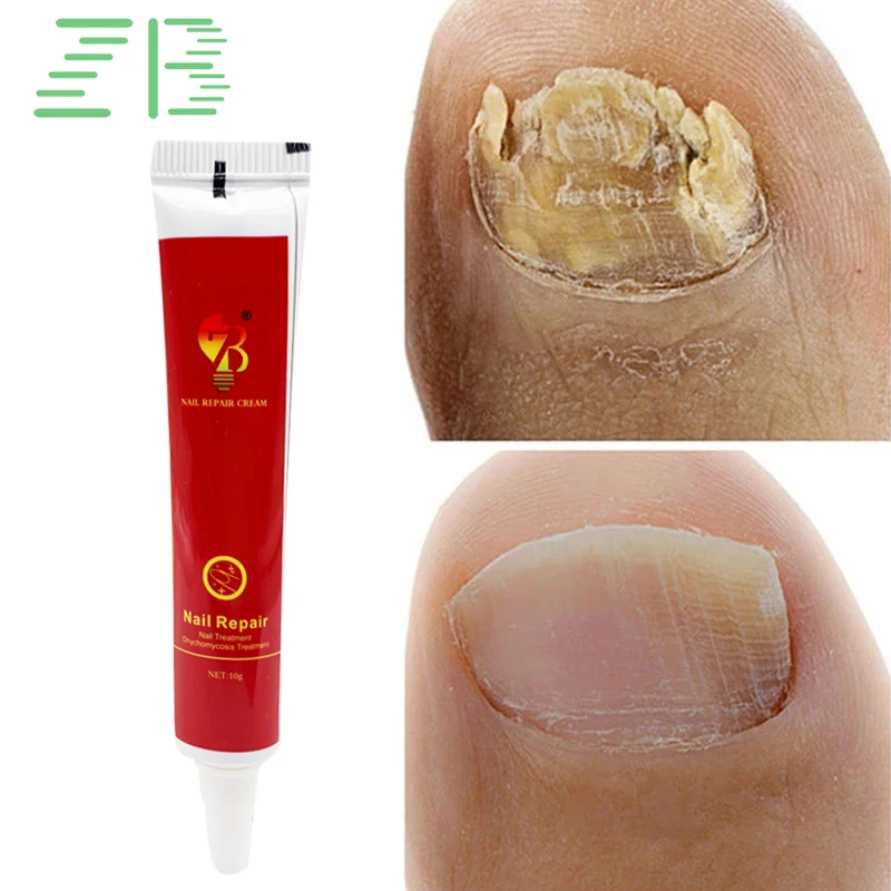 10g Nail Fungal Treatment Ointment Anti Infection Paronychia ...