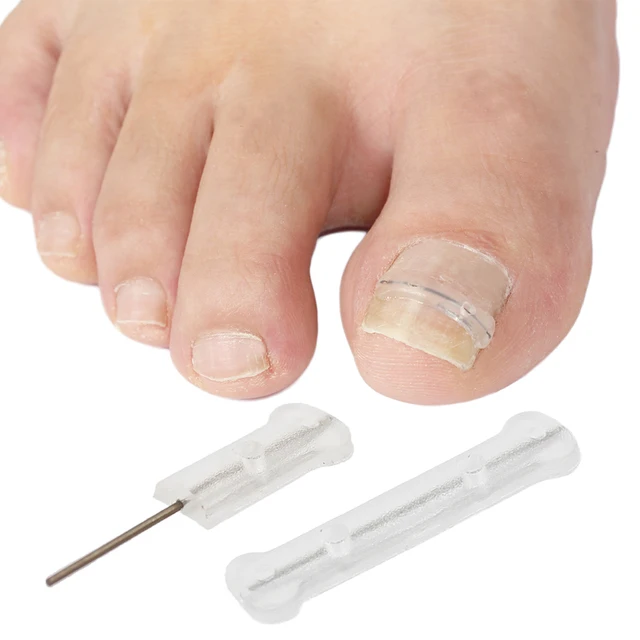 Titanium Toenail Silicone Ingrown Toenail Correction Tool | Titanium