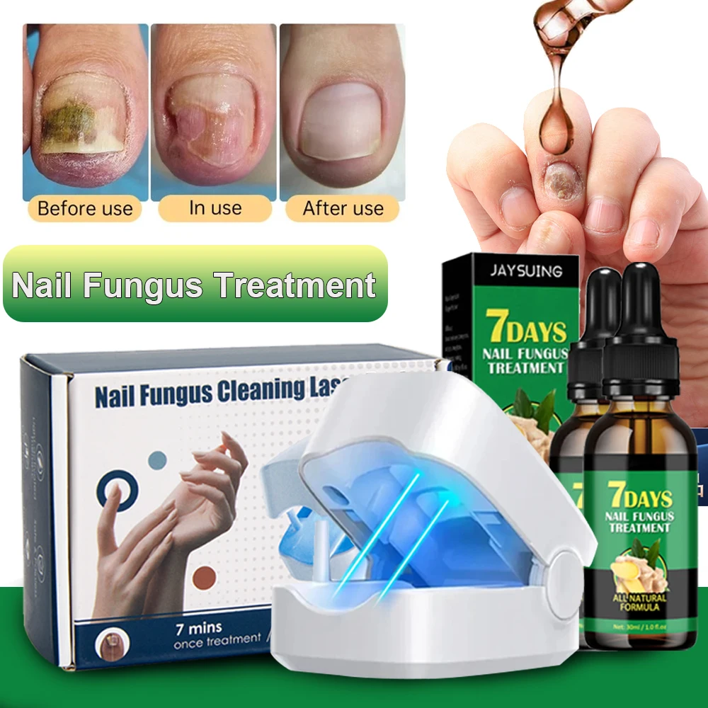 Effectively-Remove-Nail-Fungus-Device-Nail-Fungal-Essential-Oil-Repair ...