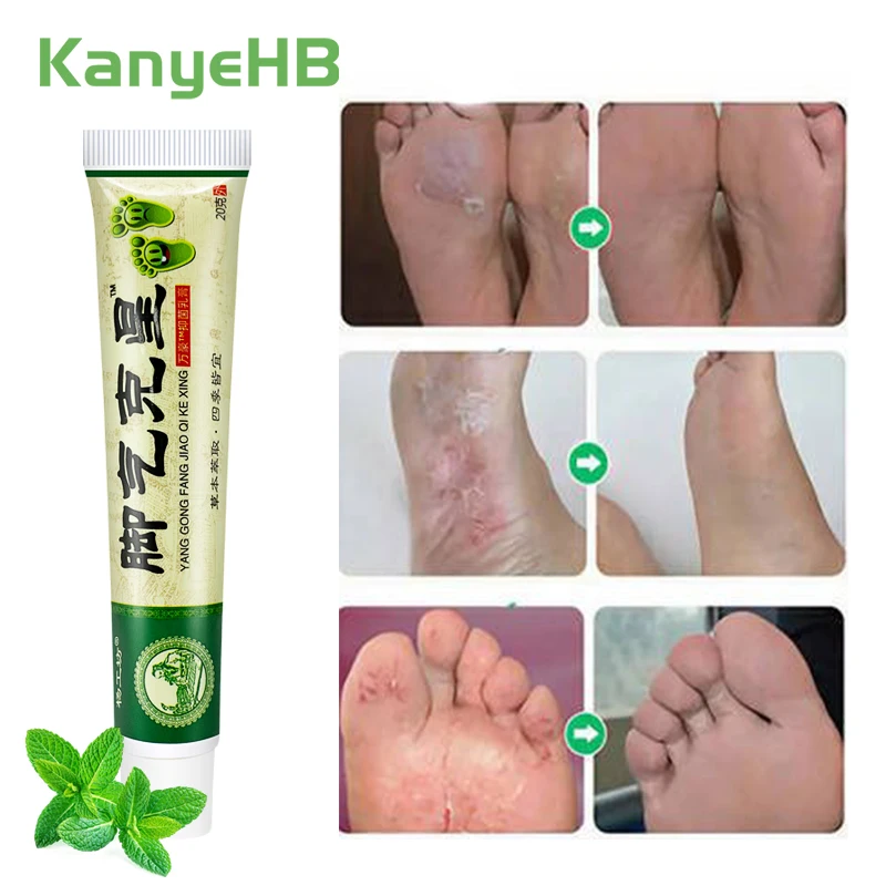 1pcs Foot Beriberi Treatment Cream Treat Foot Odor Tinea Pedis Anti-itch Inhibits Fungus Athlete ...