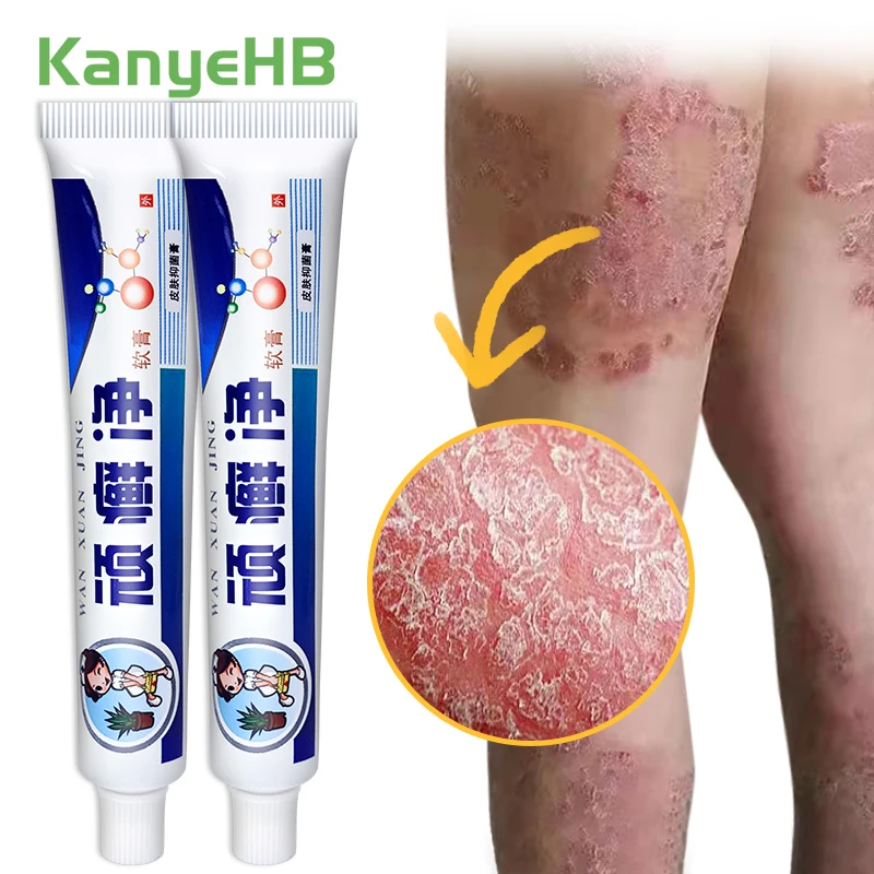 건선 크림 피부염 습진 연고 치료 비늘 조각 건선 무좀 페디스 가려움증 완화 스킨 케어 크림 A256 2 개