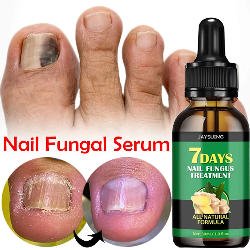 Schimmelnagel Hand Behandelen Online | www.pinnaxis.com