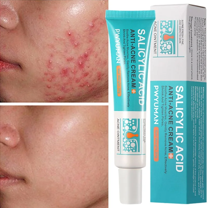 Crema-de-cido-salic-lico-para-eliminaci-n-de-acn-tratamiento-de-acn-Control-de-Aceite.jpg