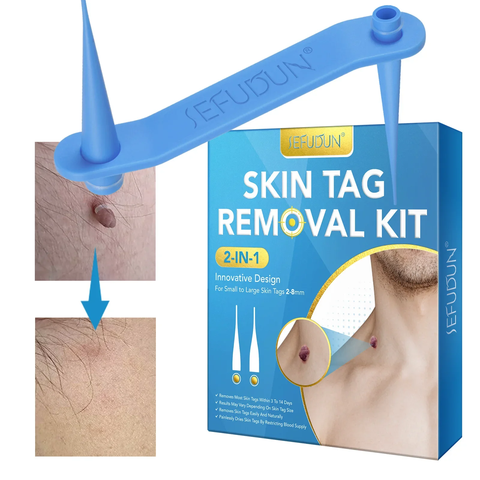 2-in-1-Simple-Wart-Removal-Tool-Kit-Painless-Skin-Labels-Fast-Effective ...