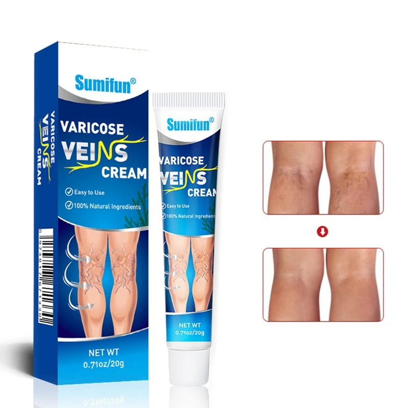 Varicose Veins Treatment Ointment Cream Relief Veins Pain Vasculitis ...