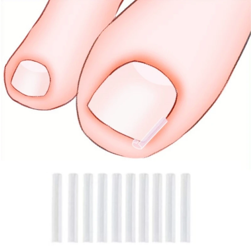 10Pcs-Ingrown-Toenail-Correction-Tool-Ingrown-Toe-Nail-Treatment ...