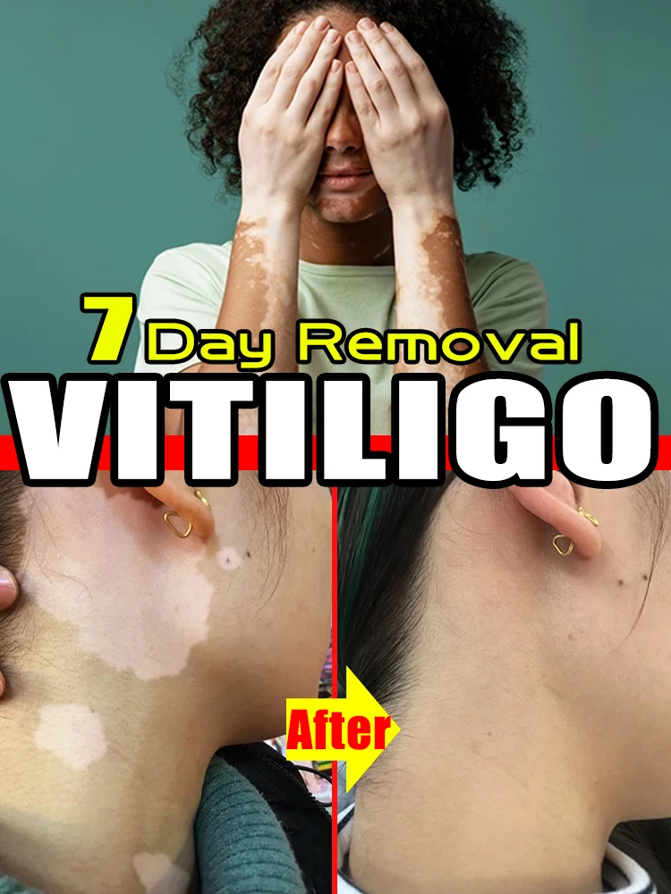 Effective-treatment-vitiligo-cream-desalination-white-spot-products.jpg