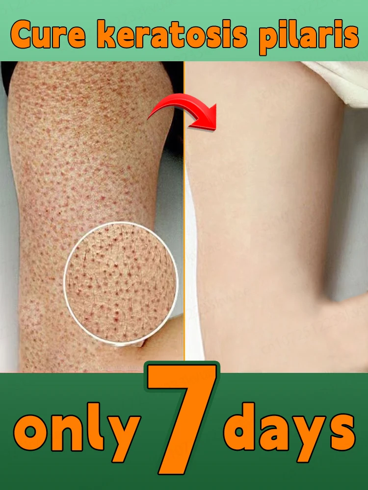 Remove-chicken-skin-and-strawberry-legs-and-return-to-smooth-skin.jpg