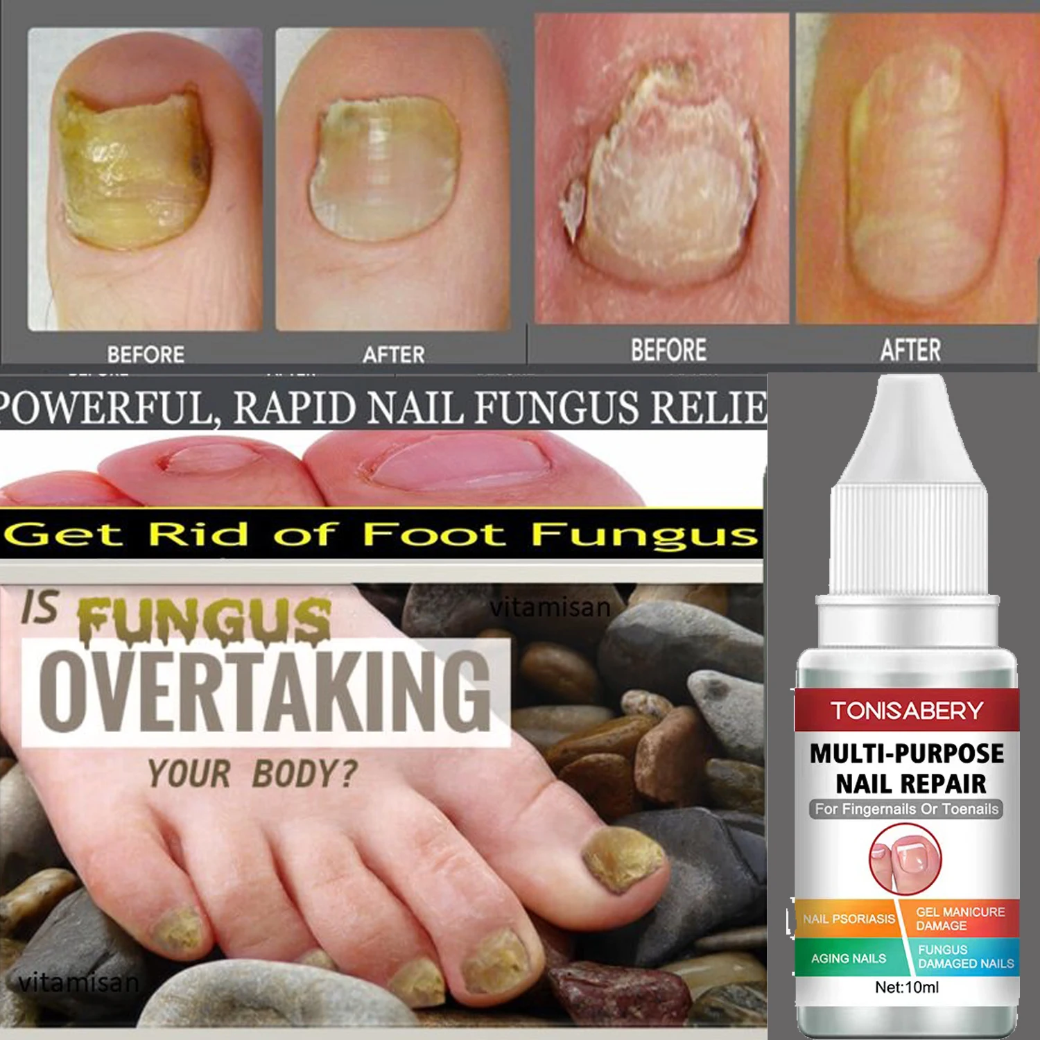 Nail-Fungal-Treatment-Essence-Anti-Infection-Feet-Cuticle-Remove-Care ...
