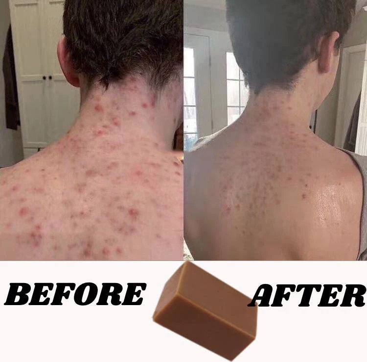 Acne Vulgaris Back