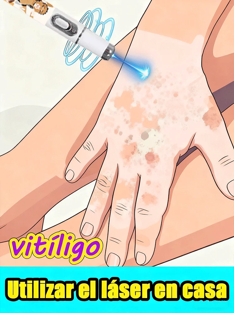 Generation-2 Blue light pen Says Goodbye To all Vitiligo In 7 Days ...