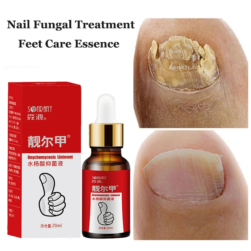 Nail Fungal Treatment Feet Care Essence Nail Foot Whitening Toe Nail ...