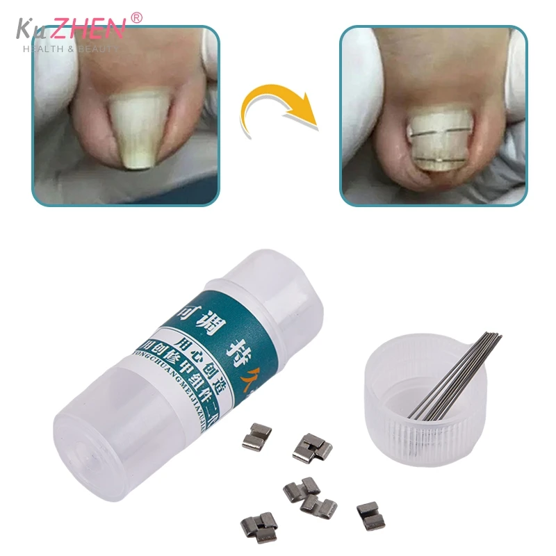 Ingrown Toenail Brace Kit: My Real Experience Fixing Chronic Pain ...