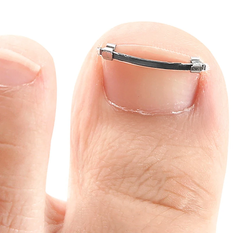 Embed Toe Nail Care Straightening Correction Clip Curved Clamp Toenails ...