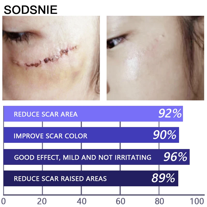 Erweiterte Atrophische Narben