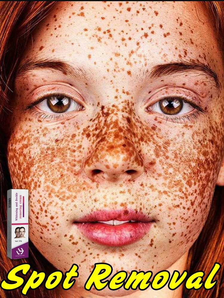 Whitening Freckle Cream Remove Freckles Melasma Dark Spots Pigment ...
