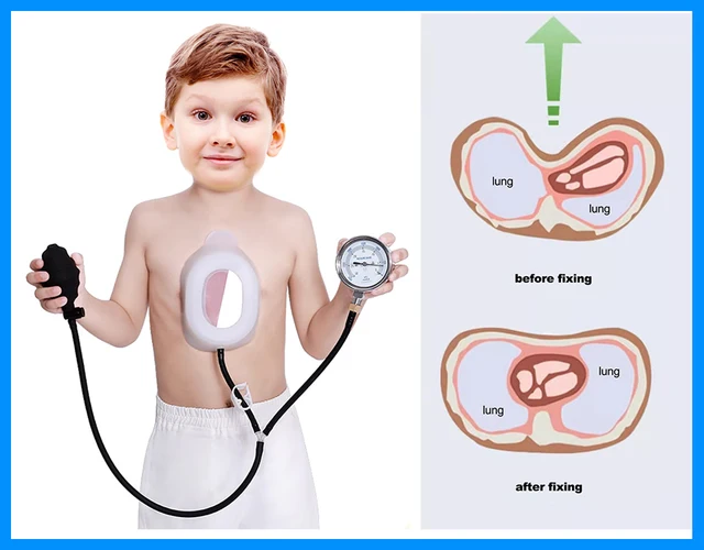 Kids Medicine Cup Pectus Excavatum Orthosis Brace Pectus Excavatum ...