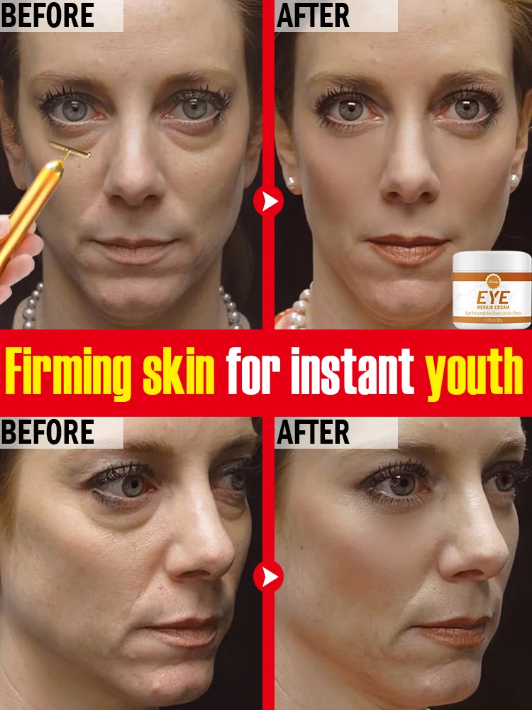 Remove-eye-wrinkles.png