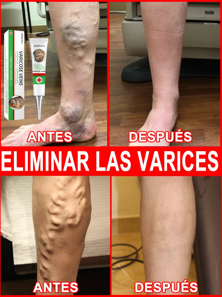 Crema-para-eliminaci-n-de-venas-varicosas-producto-mejor-contra-las ...