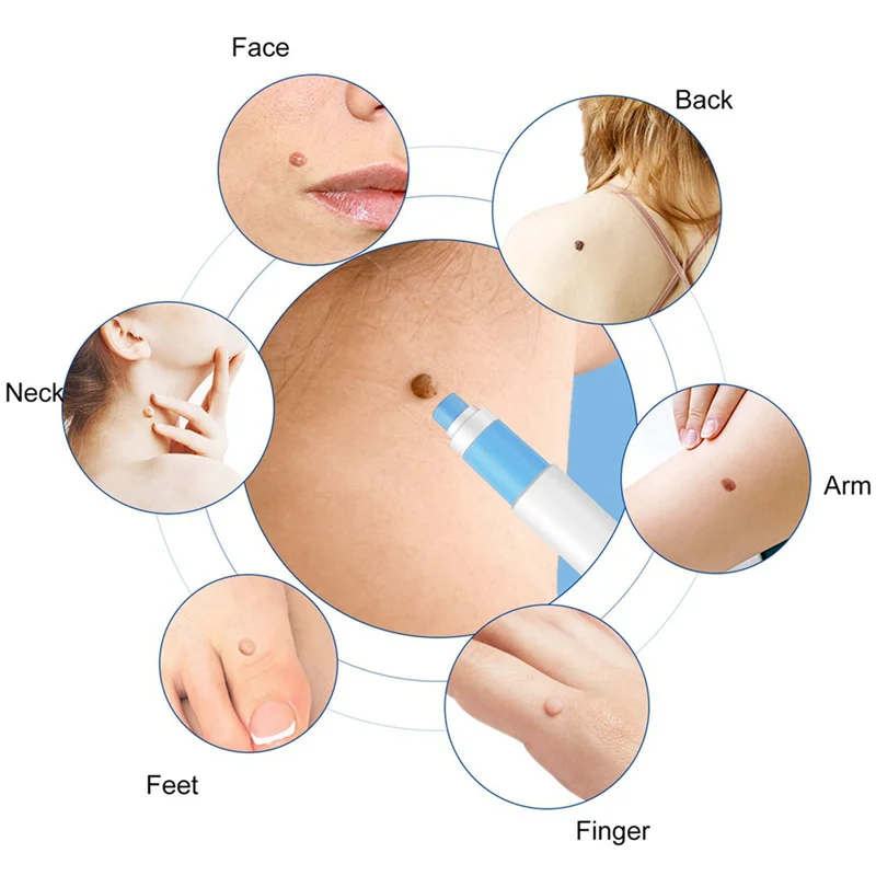 B64B-2X Skin Tag Removal Kit Painless Skin Tag Removal Pen Easy Skin ...