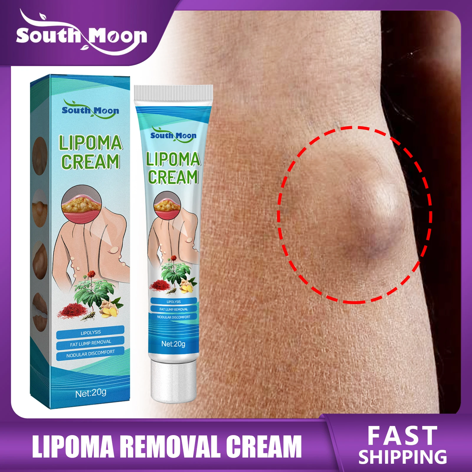 Lipoma.jpg