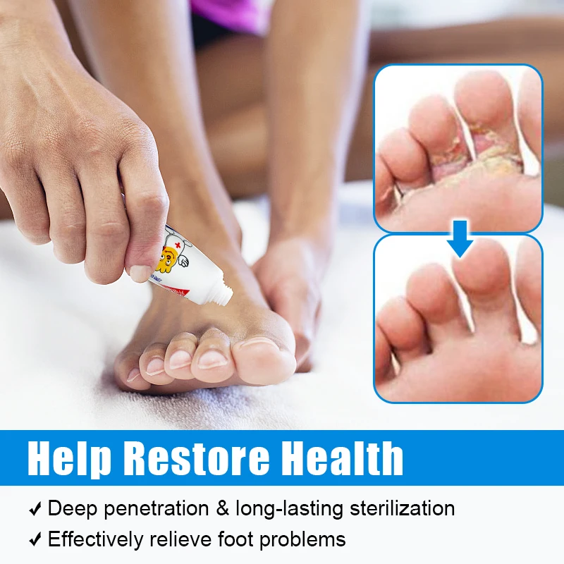 Крем от грибка ног kanyeHB 2 шт. | AliExpress