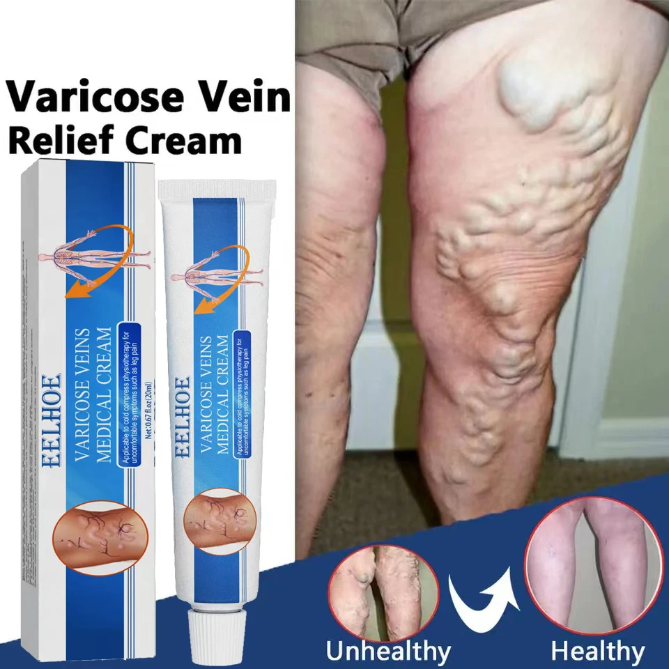 Pomada para venas varicosas, crema efectiva para aliviar las venas ...