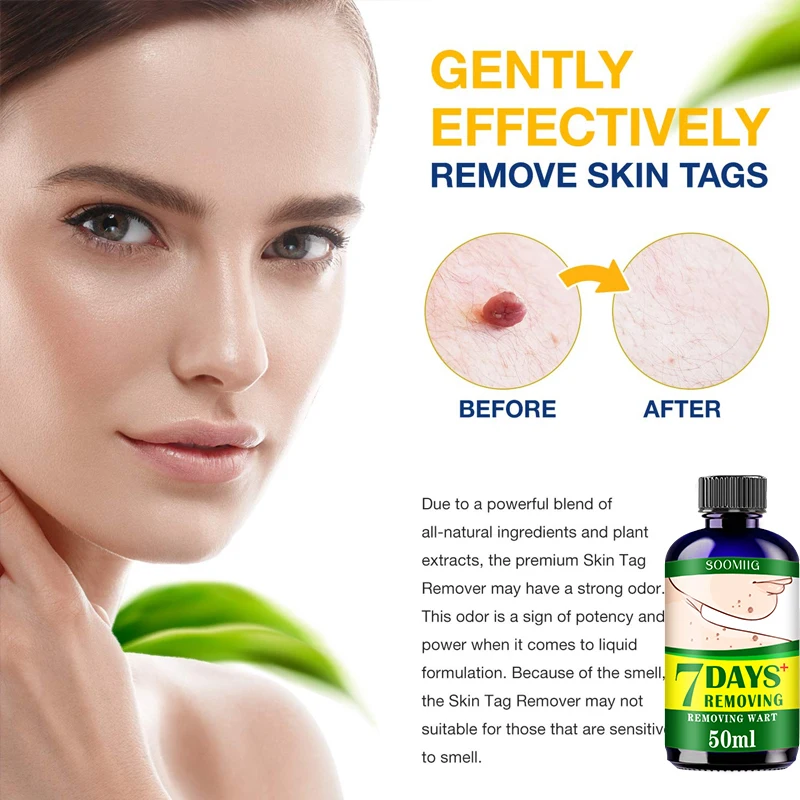 How To Remove Skin Tags On Face Naturally