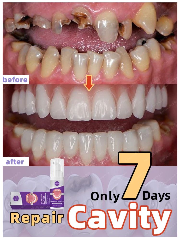 Caries-Repair-Essence-Prevent-Cavities-Protect-Teeth-Remove-Plaque-Oral ...