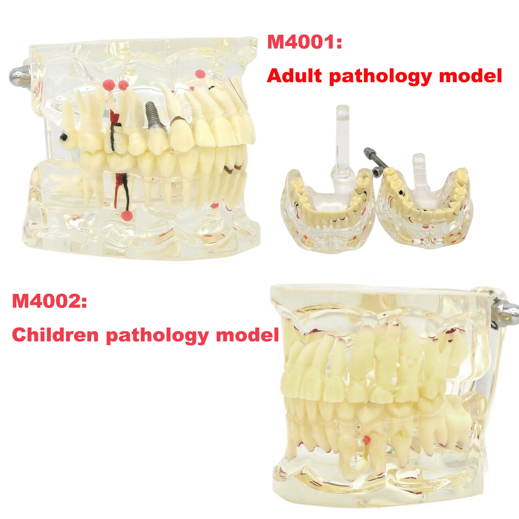 Dental-Teeth-Model-Implant-Disease-Adult-Children-pathology-Model-Tooth ...