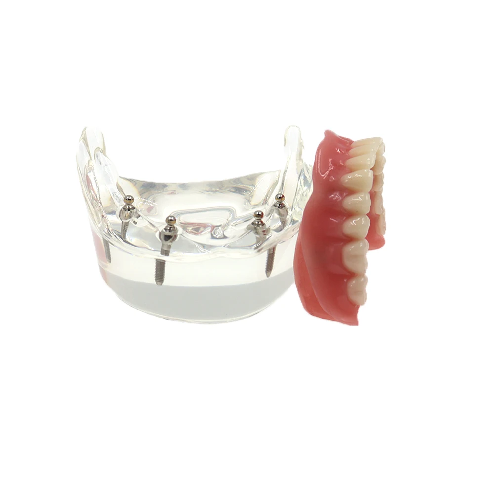 Dental-Overdenture-Inferior-with-4-Implants-Demo-Model-6003-Study-Teeth ...