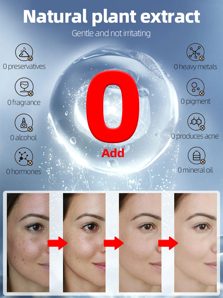 SLIBRIDGE freckle remover cream remove from pigmentation on the face ...