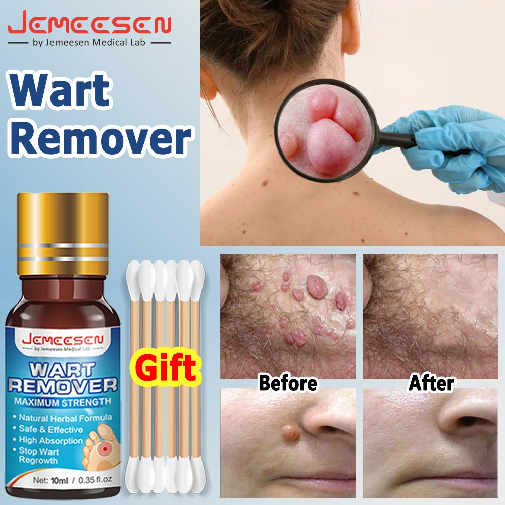 Jemeesen-Wart-Remover-Anti-Wart-Remove-Skin-Tag-Painless-Effective ...