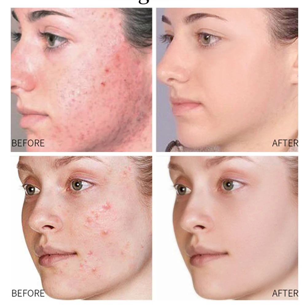 Dull Skin Before After