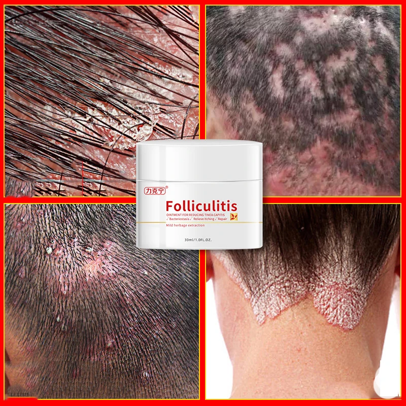 Dermatite-seborr-ica-Pomada-Cabe-a-Acne-Tinea-Capitis-Couro-cabeludo ...