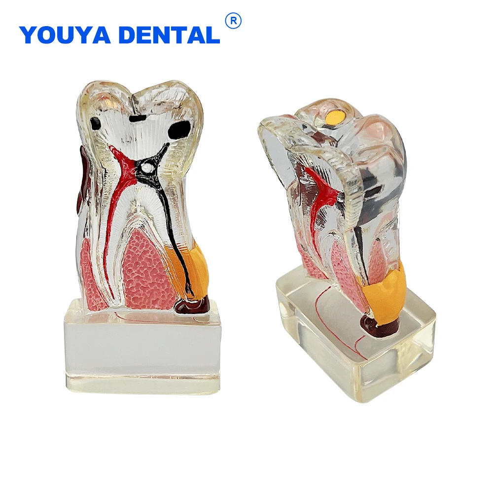 4 times Dental Teeth Model Pathology Model Transparent Molar Anatomy ...