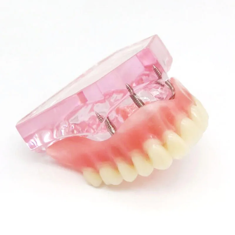 Dental-Oral-Teaching-Denture-Implant-and-Restoration-Model-Upper-Half ...