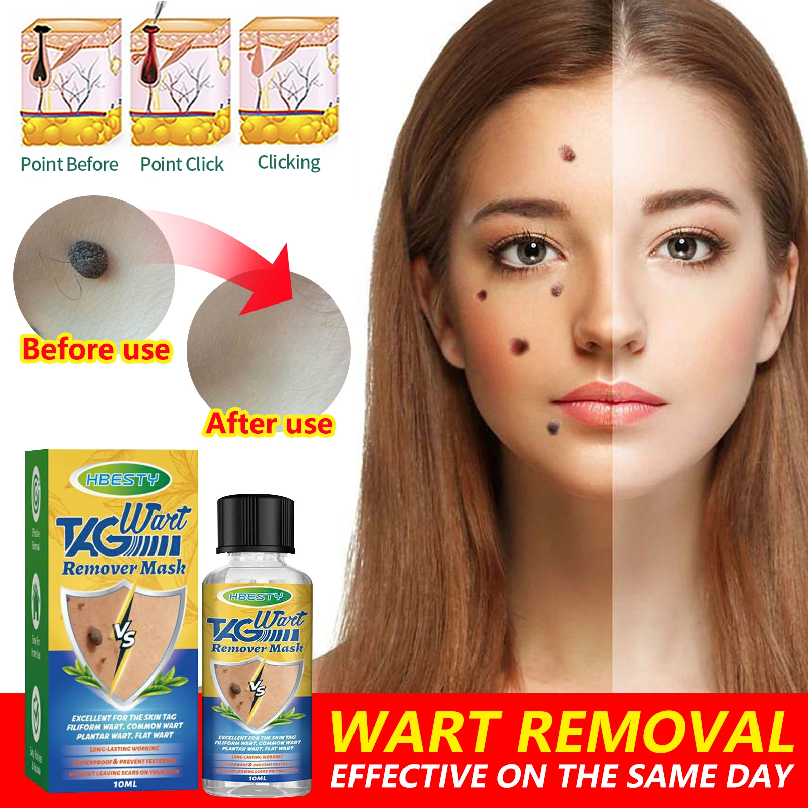 Filiform Wart Removal