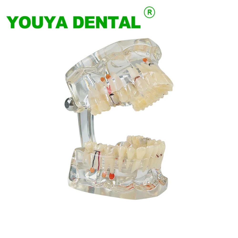 Dental Teaching Model Pathological Typodont Teeth Model Dentistry ...