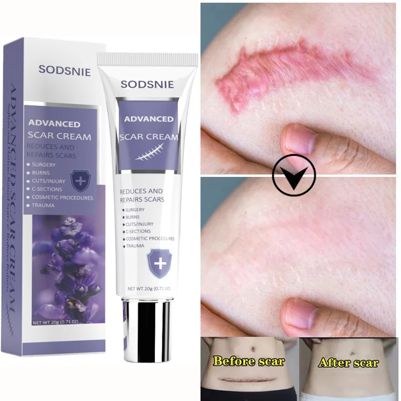 Scar-Removing-Gel-Scars-Removal-Creams-Stretch-Marks-Burn-Surgical-Scar ...