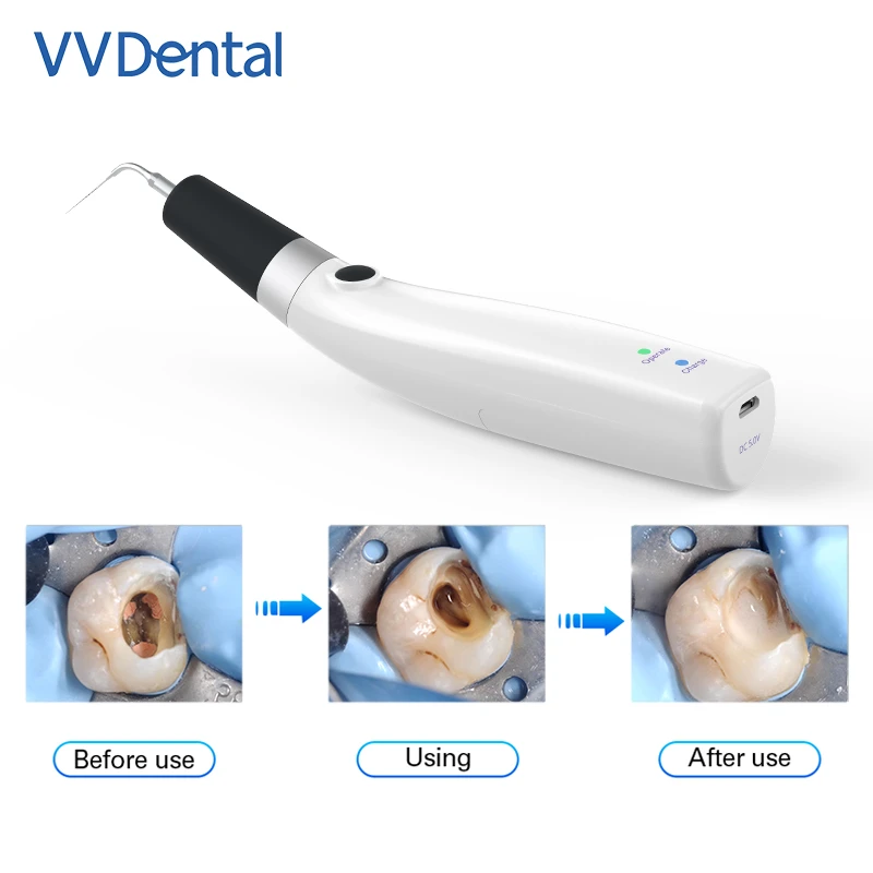 VVDental Irrigador Endodôntico Sem Fio, Endo Ultra Activator, Handpiece Dentistry, Instrumentos ...